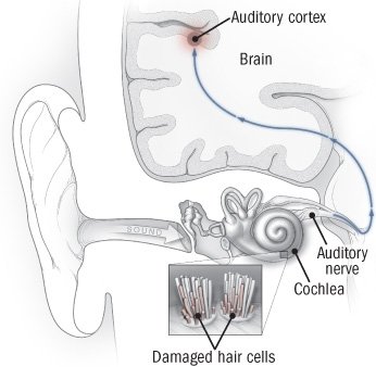 Acouphène un problème complexe du système nerveux