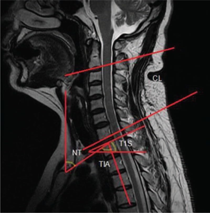 Raideur cervicale et douleur cervicale et arthrose cervicale