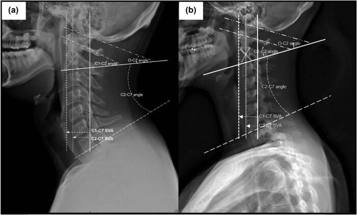 Raideur cervicale et douleur cervicale et arthrose cervicale