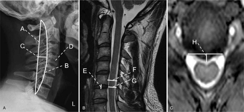 Raideur cervicale et douleur cervicale et arthrose cervicale