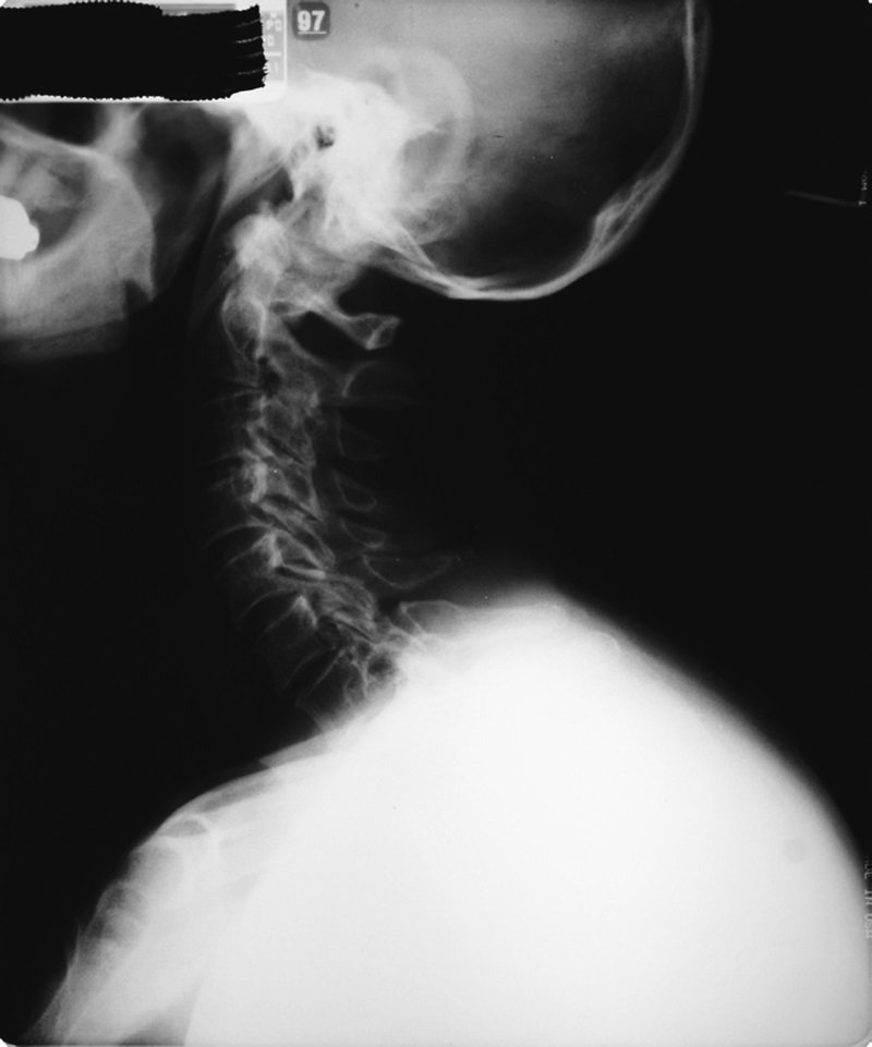 Il existe un lien entre raideur cervicale et la fibromyalgie