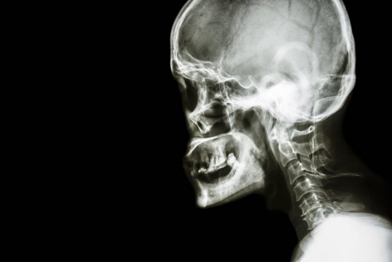 Correction de la raideur cervicale et plasticité cérébrale